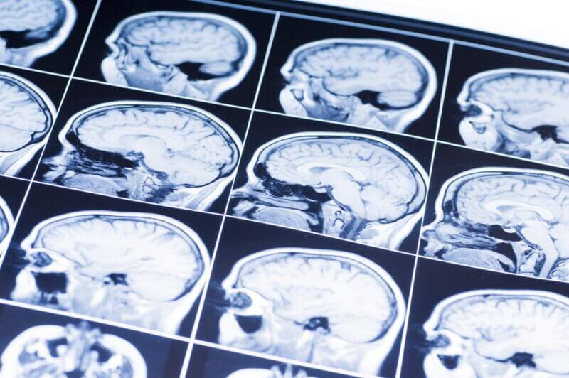 What Happens to Your Brain After a Car Accident? - MG Law